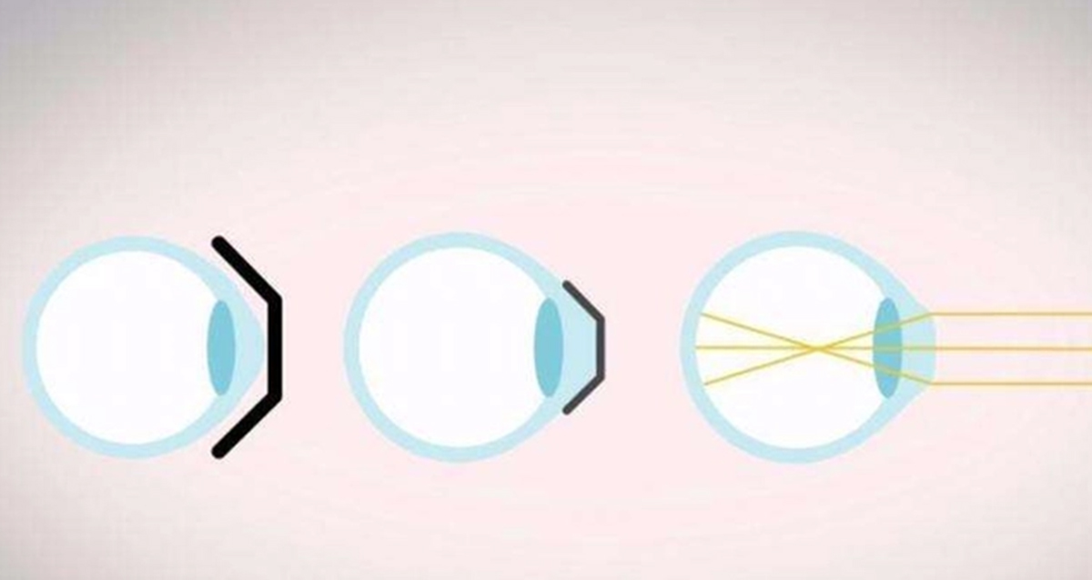 What Is A Defocus Lens